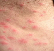 La Gale - Médecine Intégrée