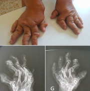 Polyarthrite rhumatoïde - Médecine Intégrée