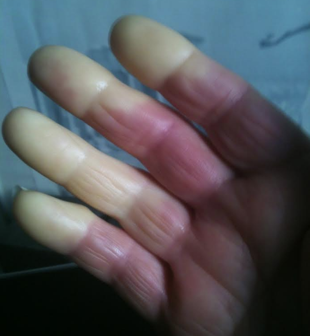 Engelures - syndrome de Raynaud - Médecine Intégrée