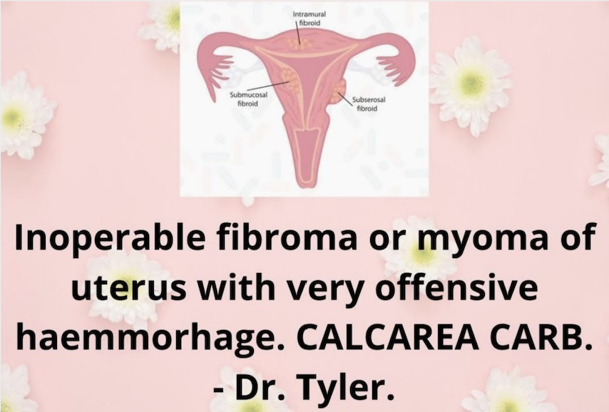 Fibromes et polypes - Médecine Intégrée