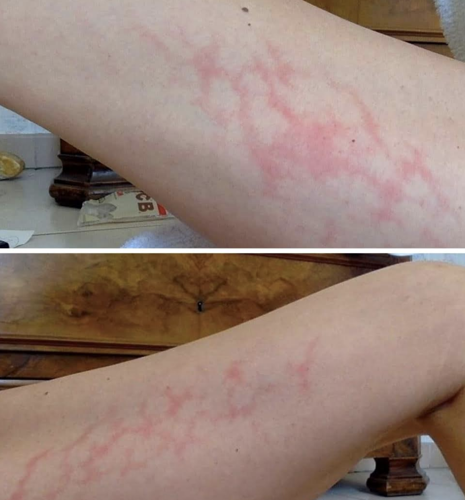 Livedo - Médecine Intégrée