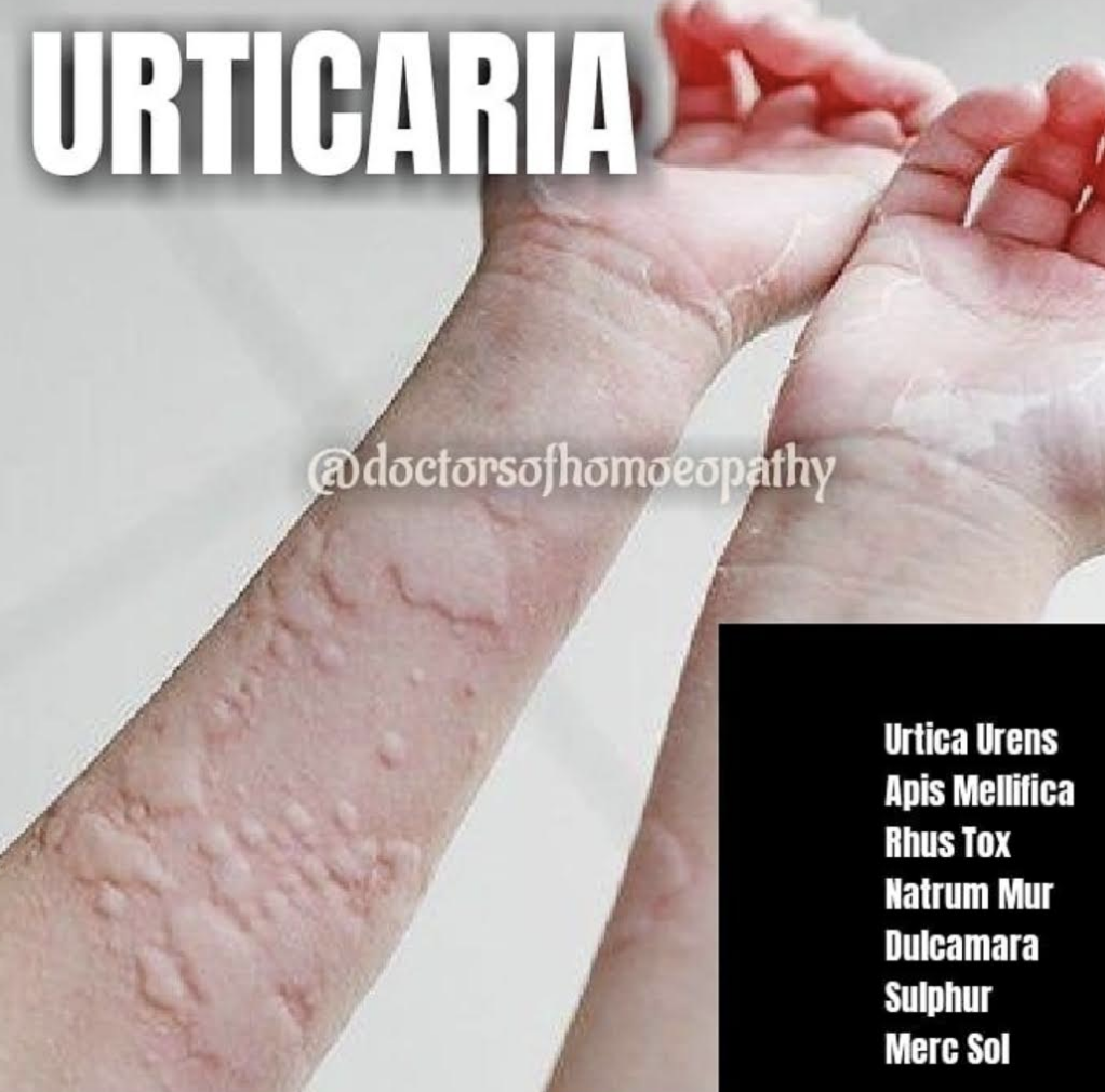 Urticaire - Médecine Intégrée