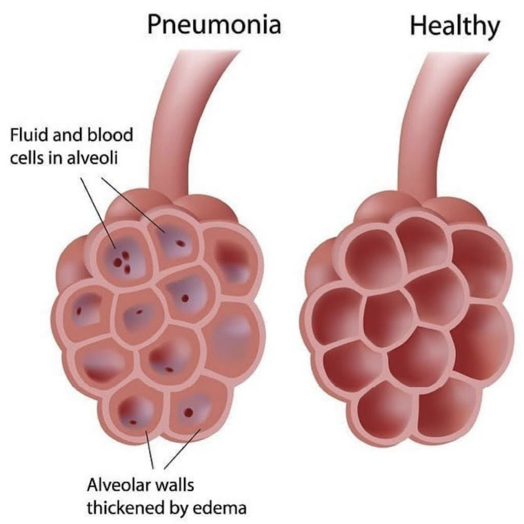 Pleuro-pulmonaire (Sémiologie chap.2) - Médecine Intégrée