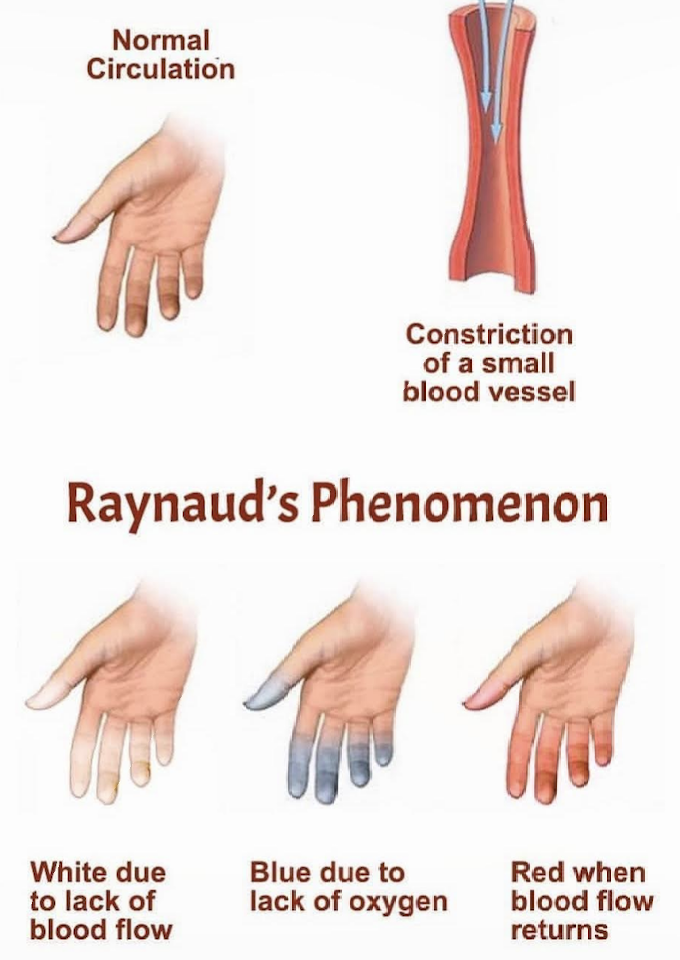Engelures - syndrome de Raynaud - Médecine Intégrée