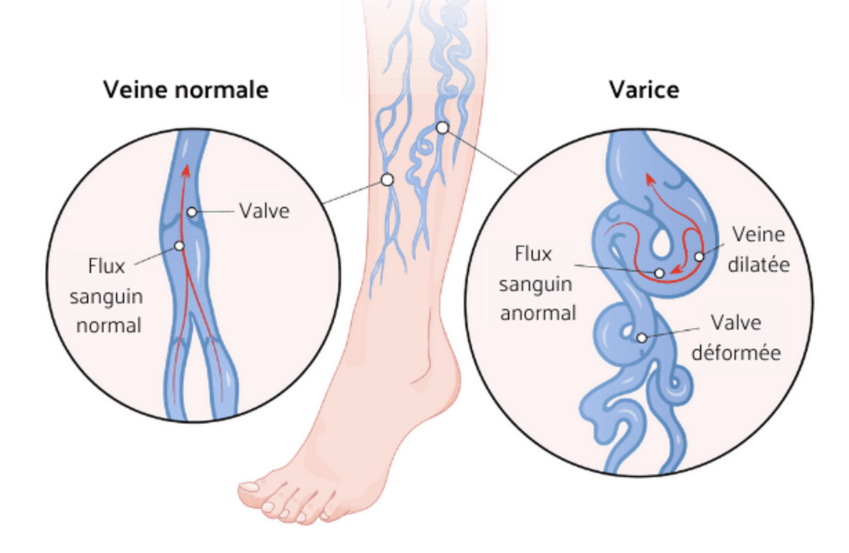 Les varices - Médecine Intégrée