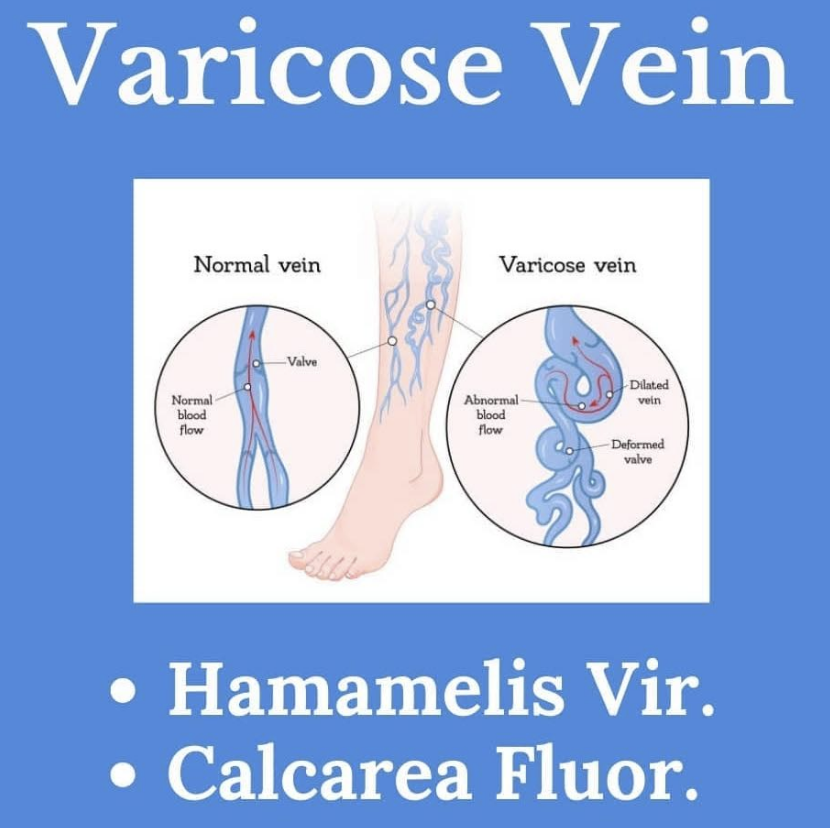 Les varices - Médecine Intégrée