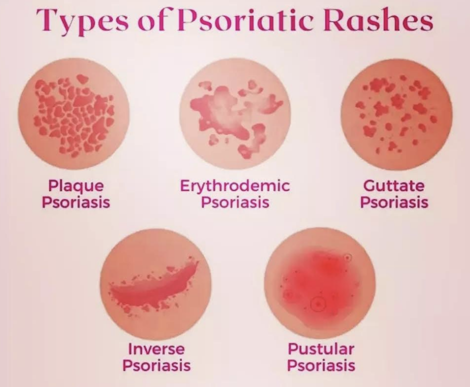 Psoriasis - Médecine Intégrée