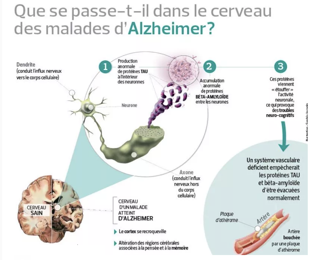 Maladie d'Alzheimer - Médecine Intégrée