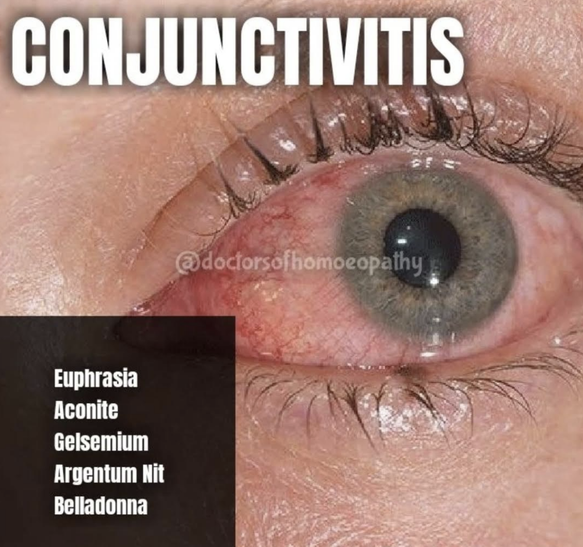 Conjonctivites - Médecine Intégrée