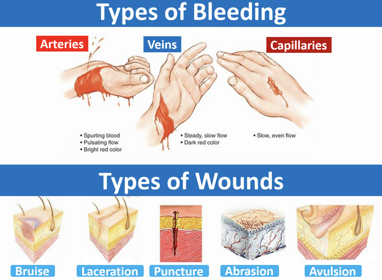 Les saignements / hémorragies - Médecine Intégrée