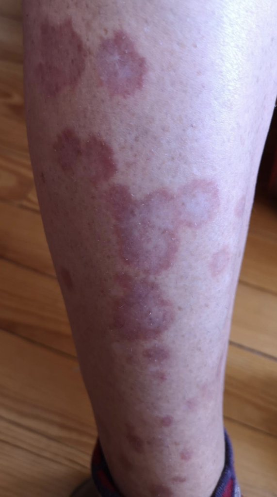 Granulome annulaire - Médecine Intégrée