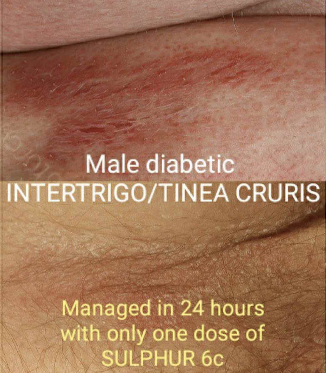 Intertrigo - Médecine Intégrée